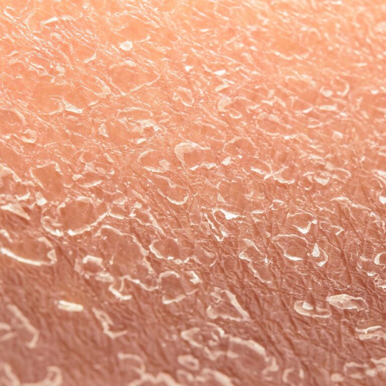 Dry Skin - Blue Ridge Dermatology