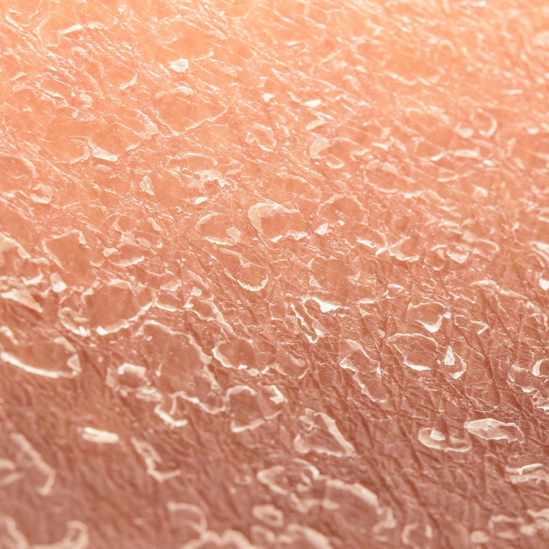 Dry Skin - Blue Ridge Dermatology