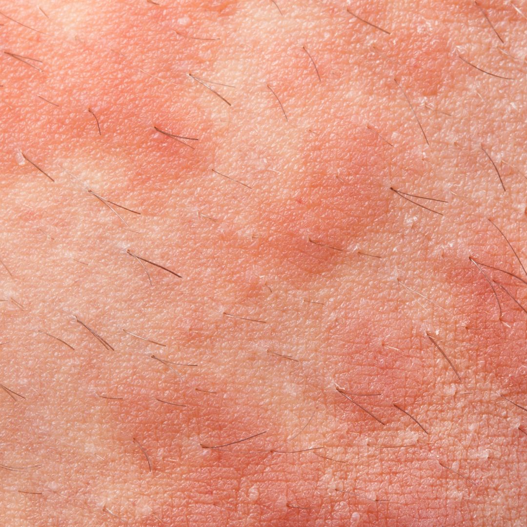 Eczema - Blue Ridge Dermatology