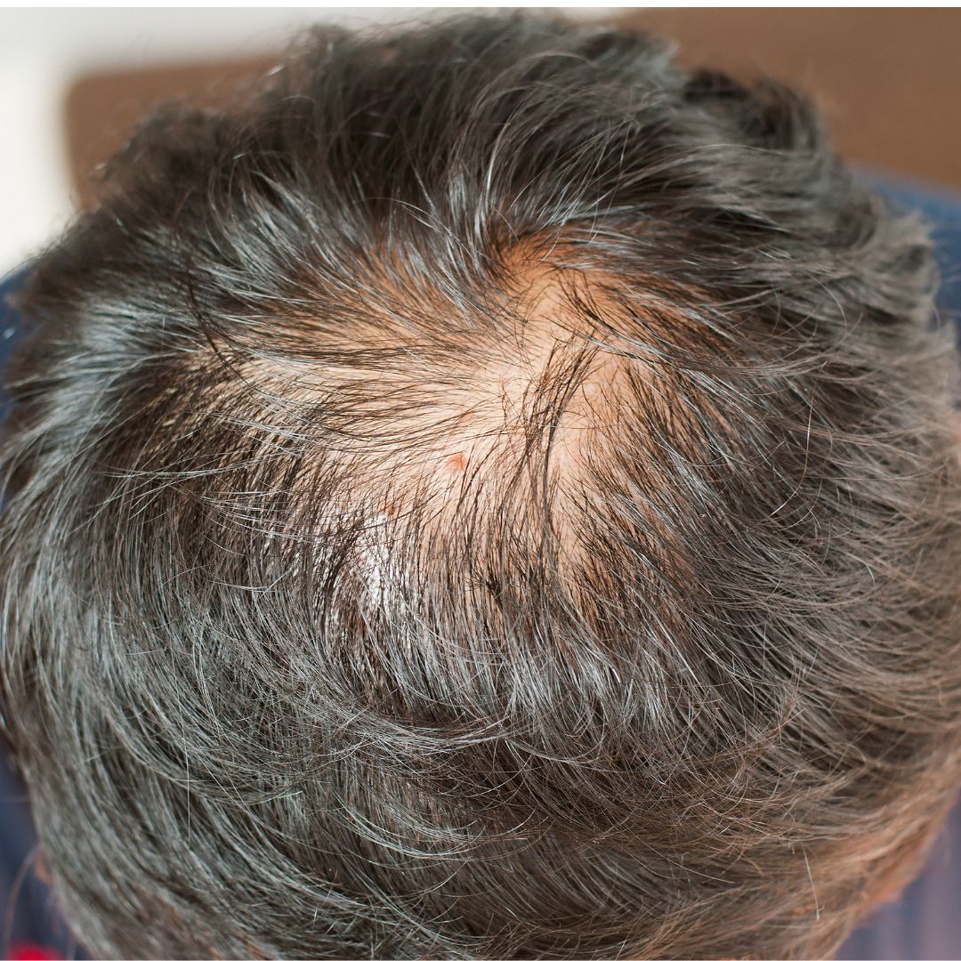 Hair Loss - Blue Ridge Dermatology